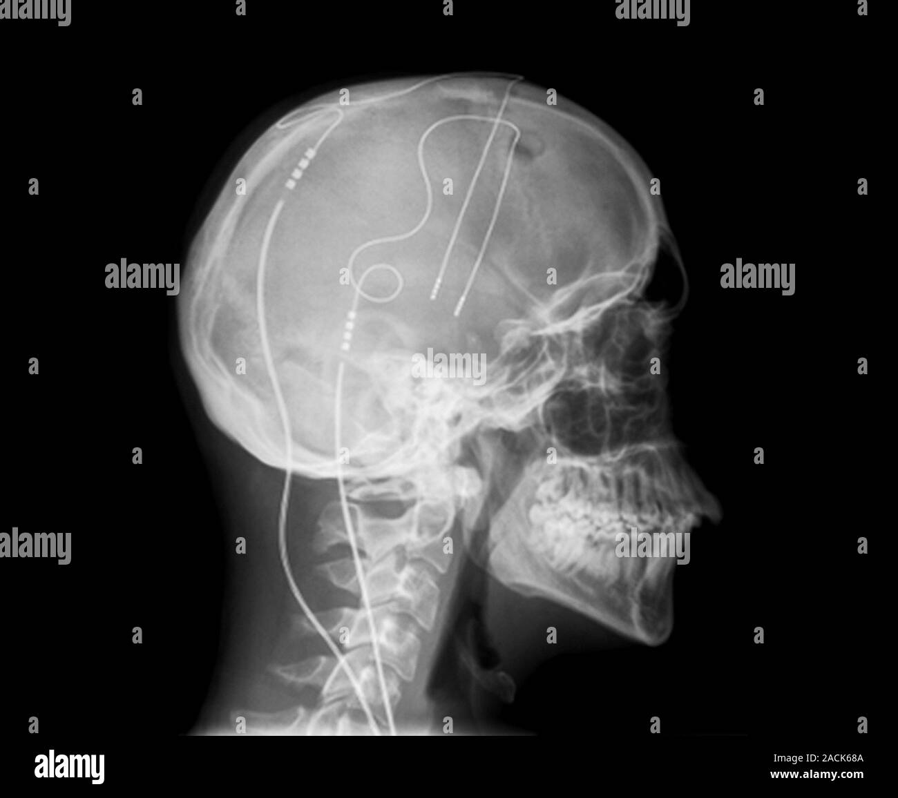 Tourette's treatment, X-ray. Profile view of the skull of a 25-year-old ...