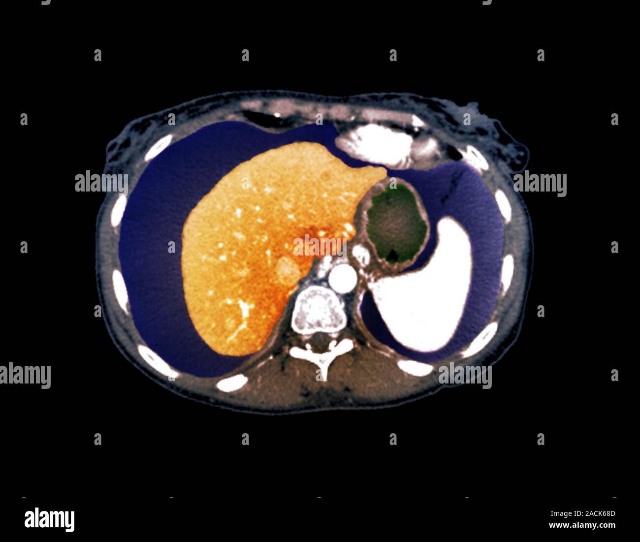 Chronic liver disease. Coloured computed tomography (CT) scan of an ...