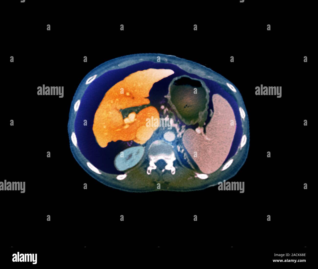 Chronic liver disease. Coloured computed tomography (CT) scan of an ...