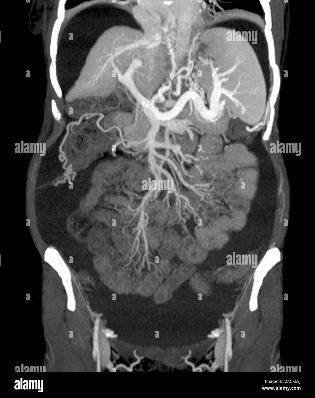 Chronic liver disease. Frontal computed tomography (CT) scan of a ...