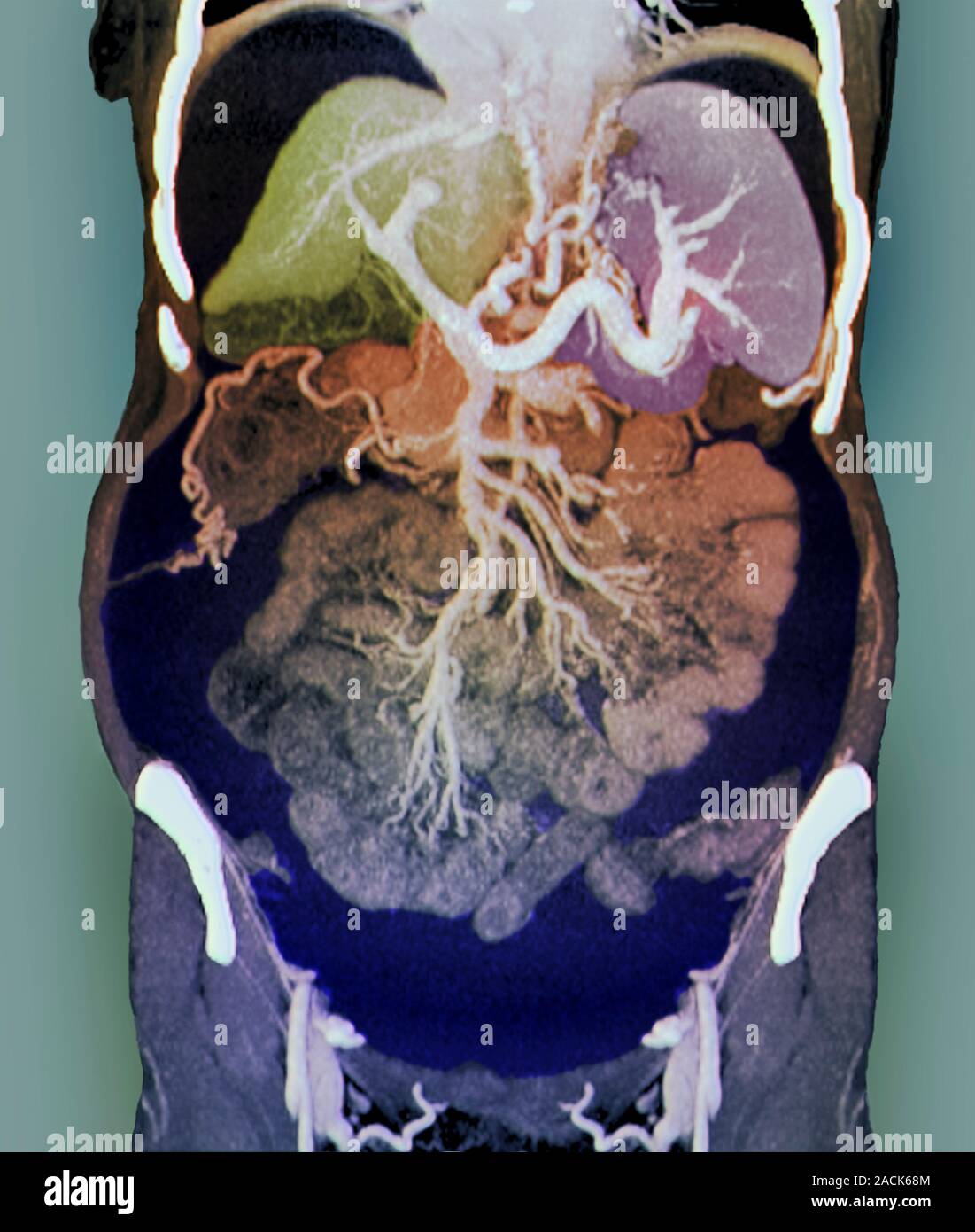 Chronic liver disease. Frontal coloured computed tomography (CT) scan of a section through the ...