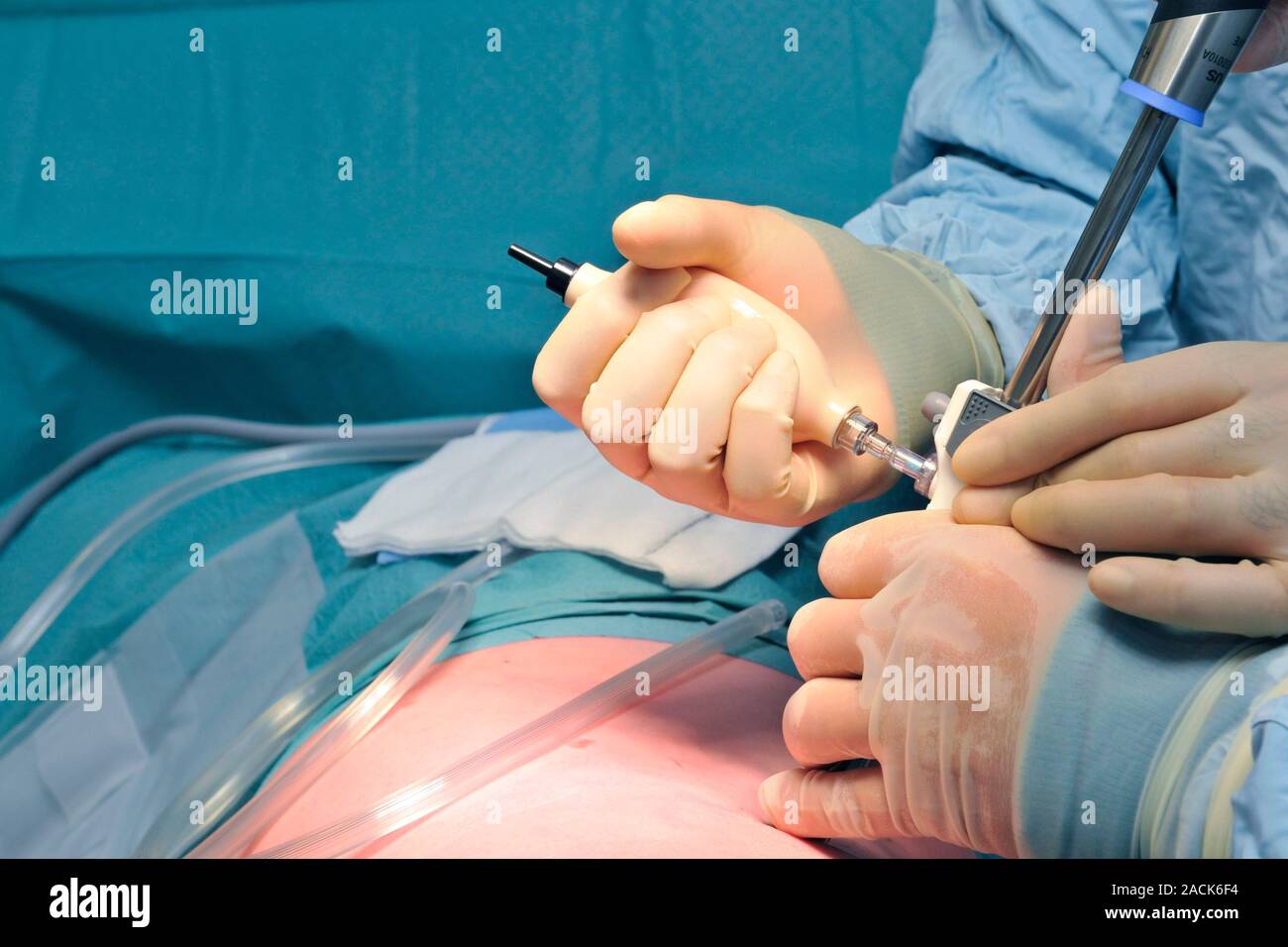Keyhole kidney removal surgery. Close-up of minimally invasive ...