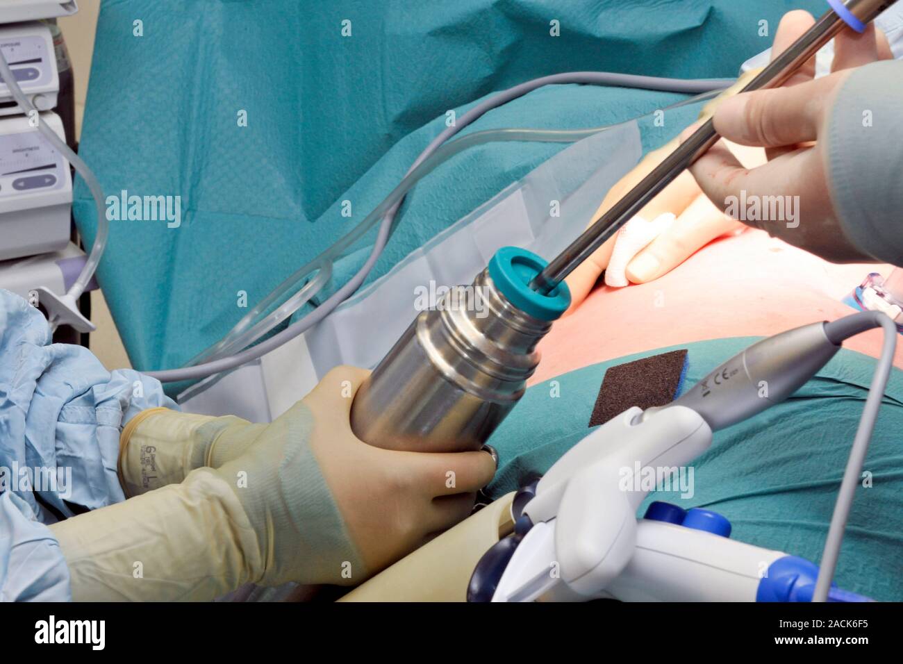 Keyhole kidney removal surgery. Close-up of surgeons performing ...