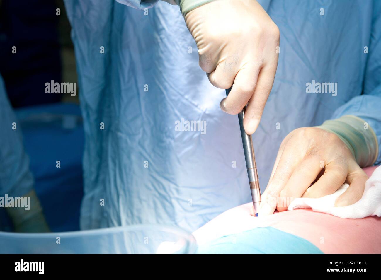 Robotic surgery. Surgeon inserting a laparascope, used by a Da Vinci ...