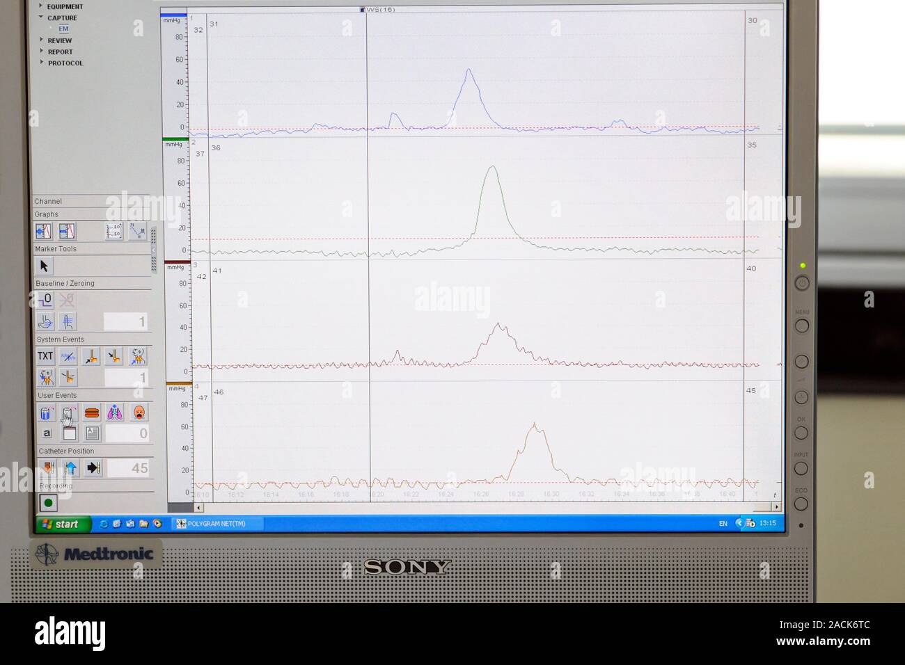 Oesophageal manometry and pH testing reults. The former allows the ...