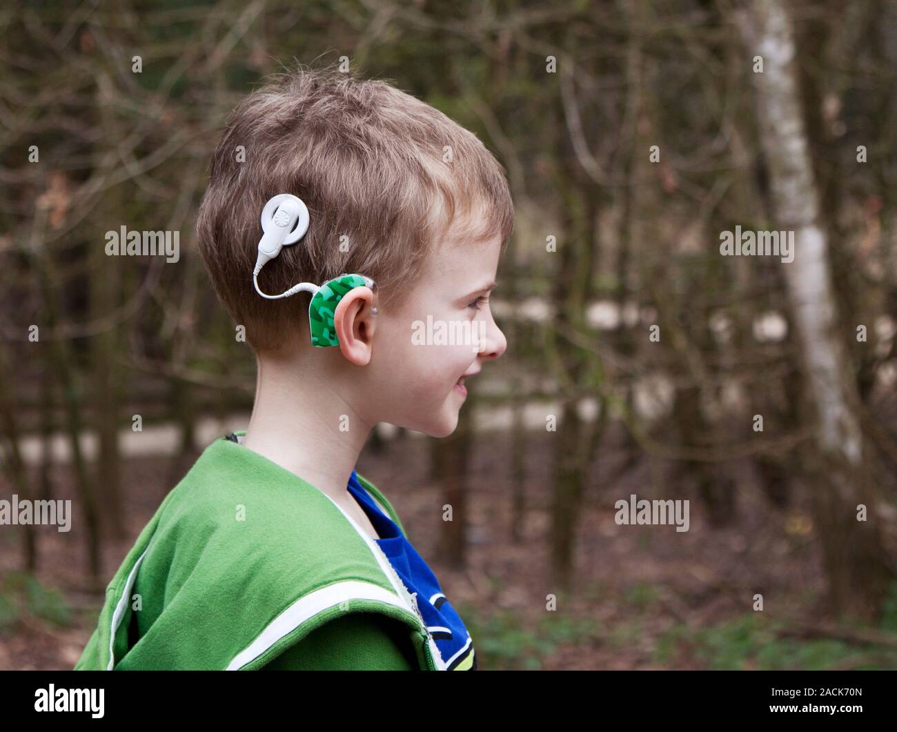 This is a real situation. Image not to be used in a defamatory context. Bilateral cochlear ...