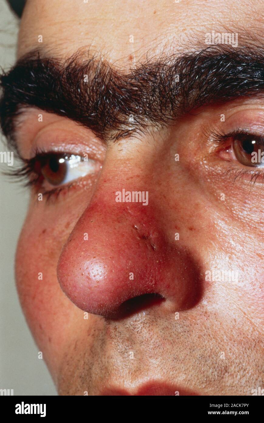 Lupus And Nose Sores at Daniel Armes blog