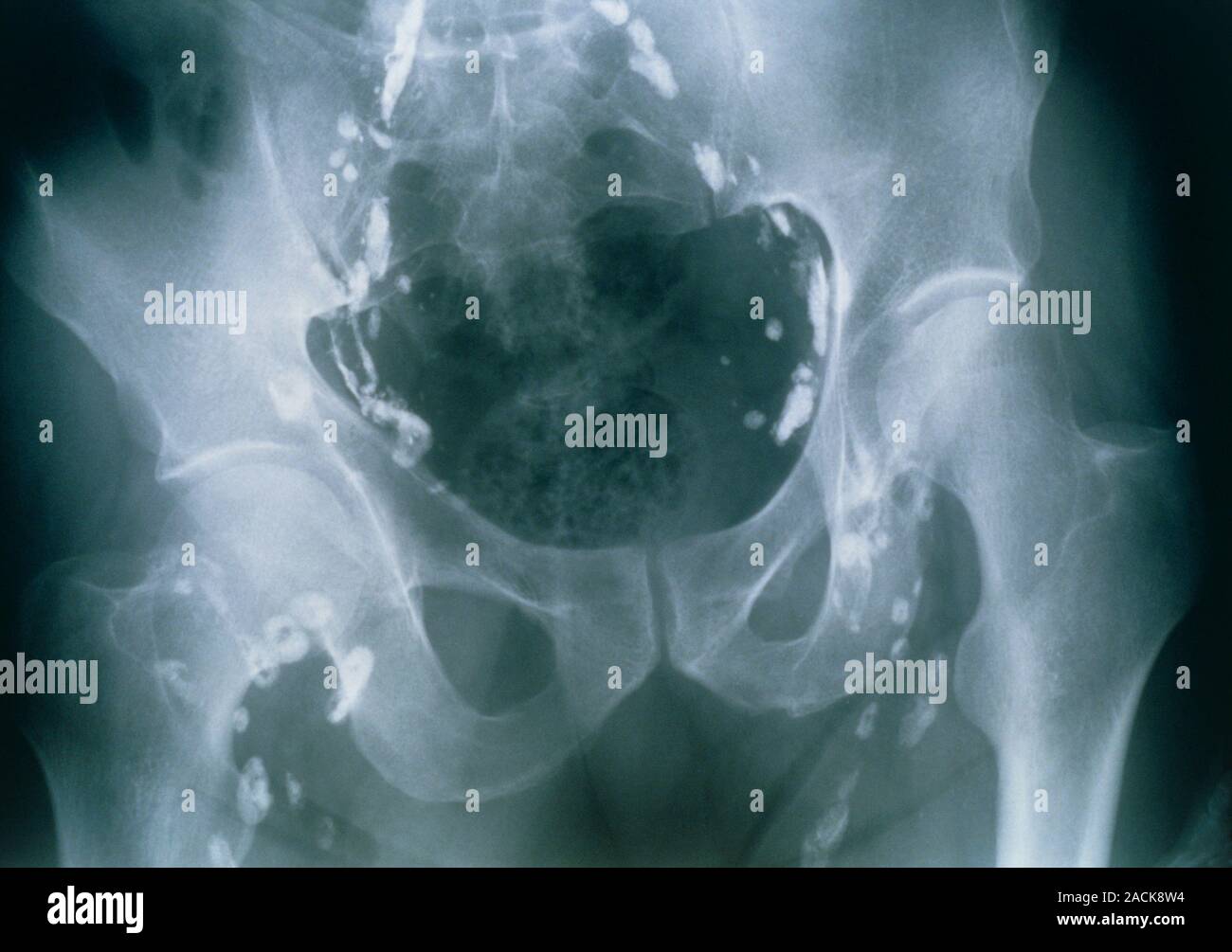 Pelvic lymph nodes. Lymphography (lymph vessel X-ray) of the pelvic ...