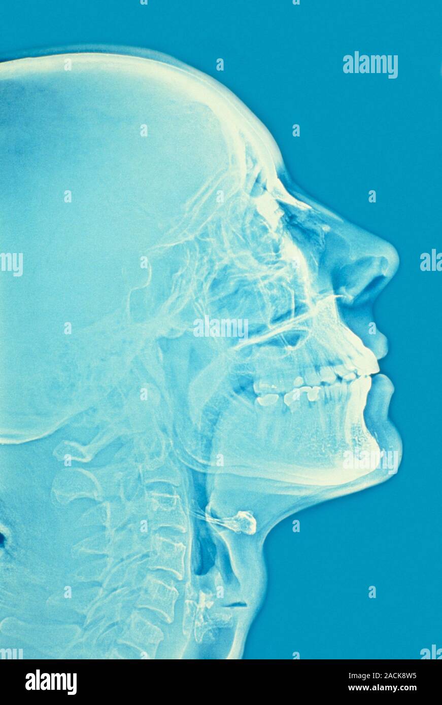 Human head. X-ray of a human head in profile, showing the bones and ...