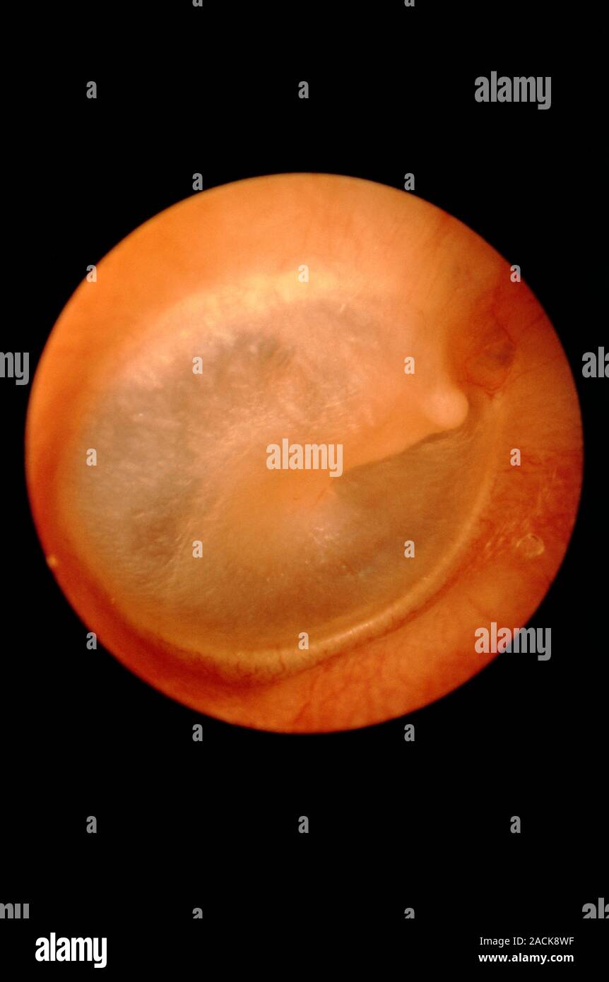 Eardrum, otoscope view. The eardrum (tympanic membrane) separated the ...