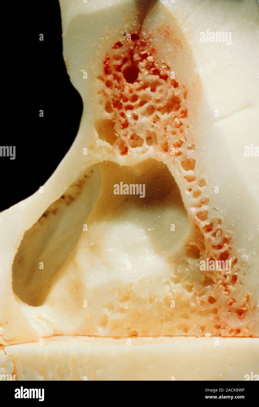 Frontal sinus. Anatomical dissection of part of the skull, showing a ...