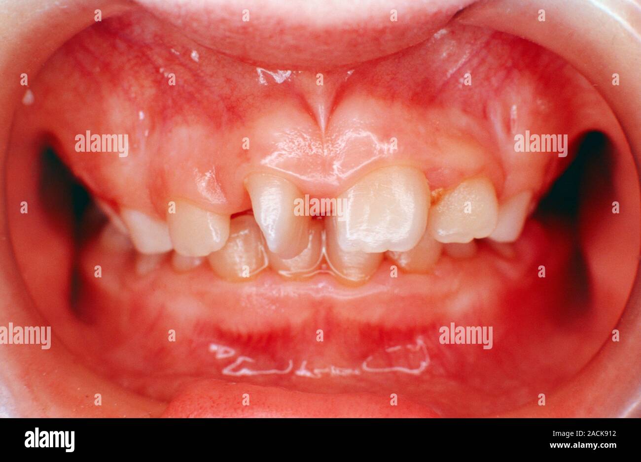 Rotated incisor. Clinical view of the teeth of an orthodontic patient ...