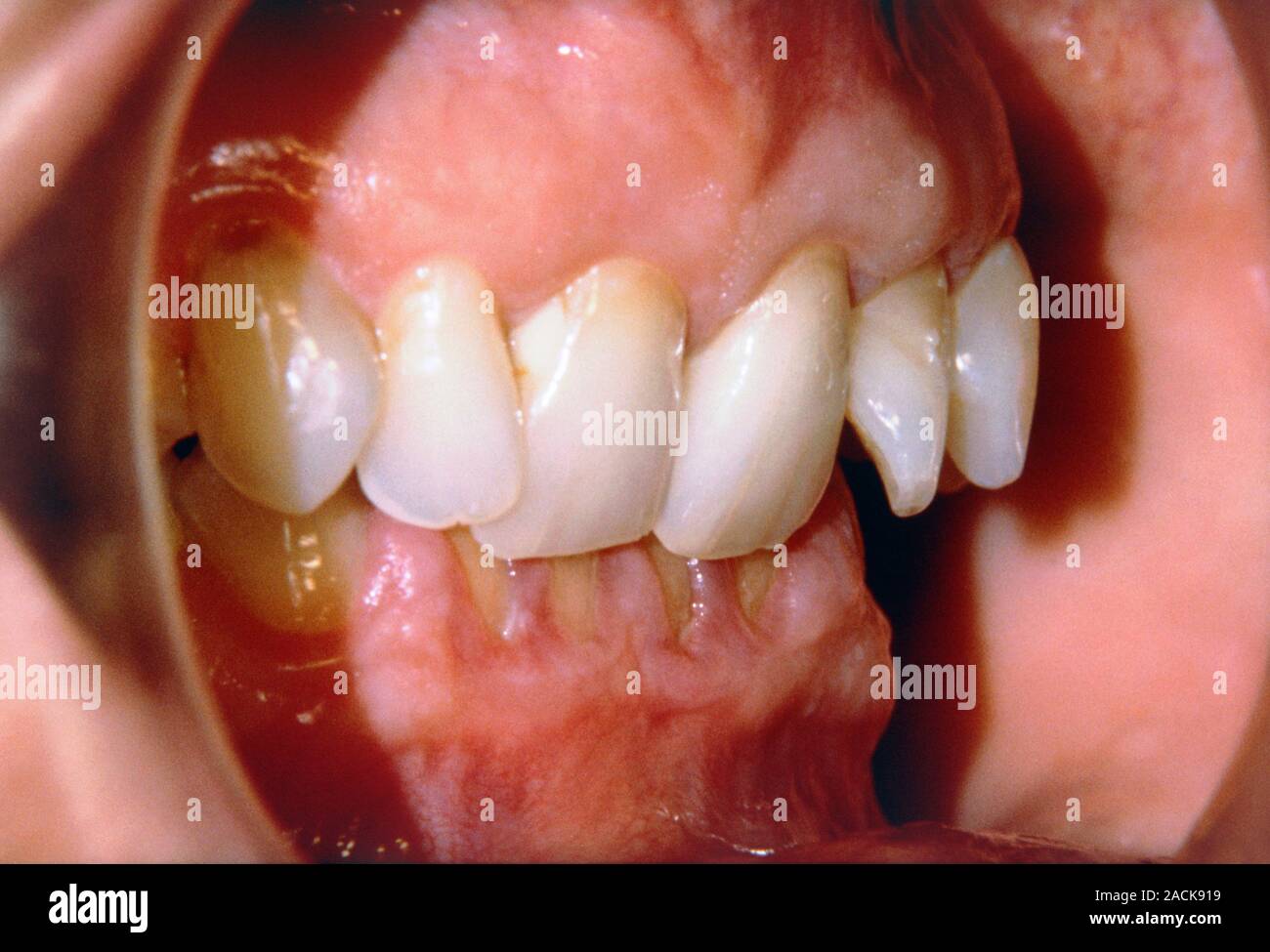 Mandibular retrognathism. Clinical view of the teeth of an orthodontic ...