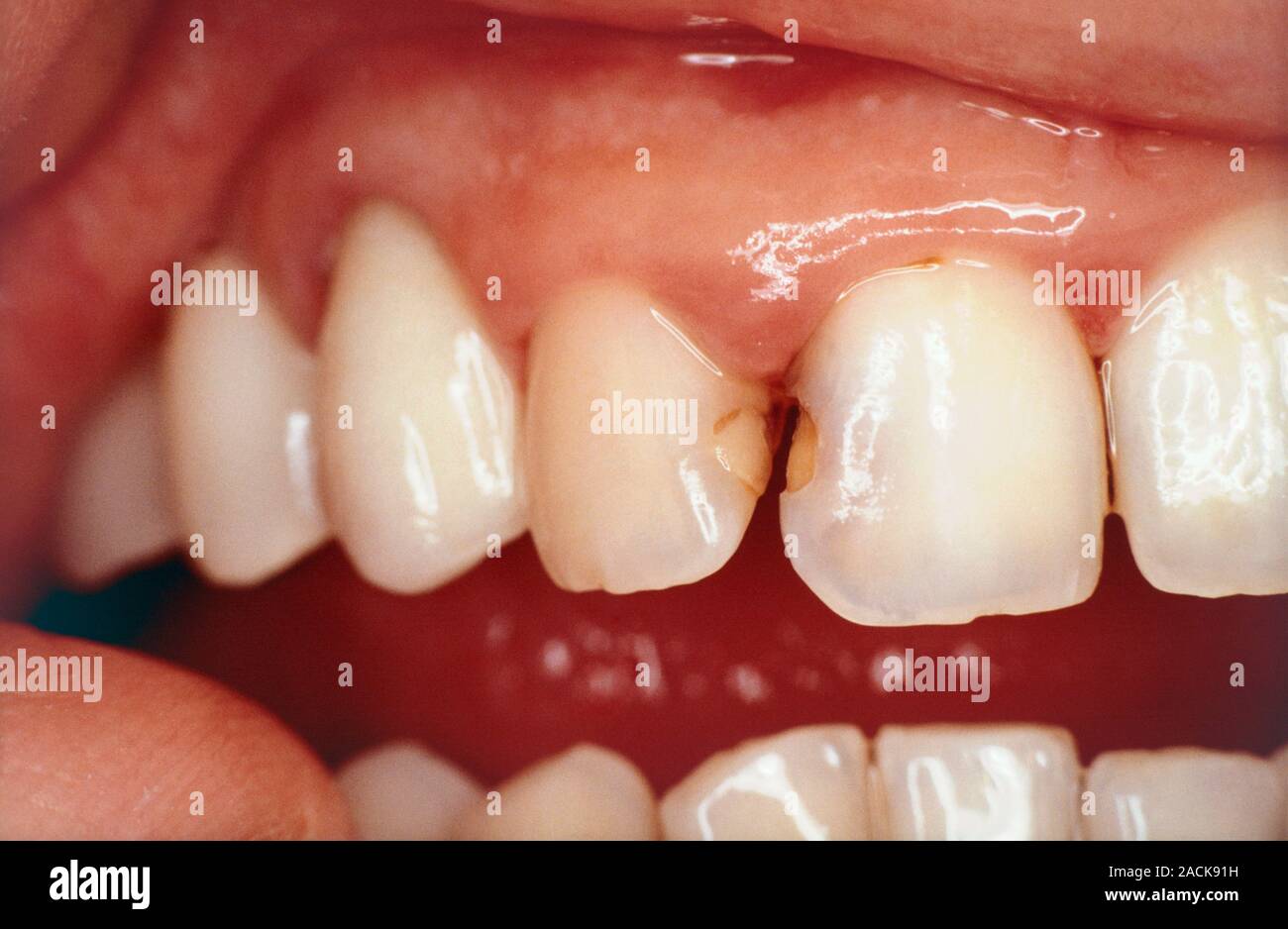 Tooth decay. Clinical view of the teeth of a patient with areas of ...