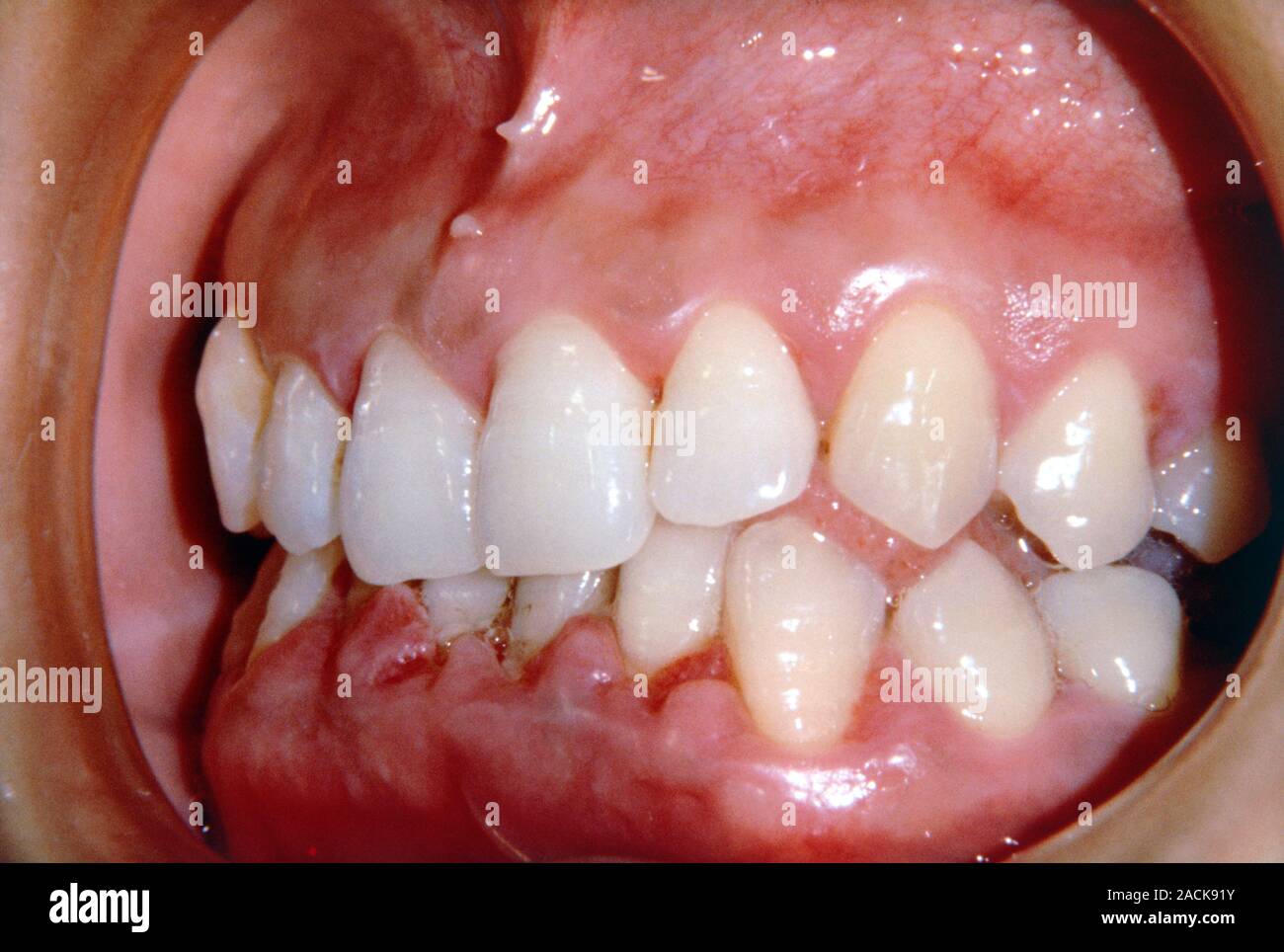 Gum inflammation. Clinical view of the teeth and gums of a patient with ...
