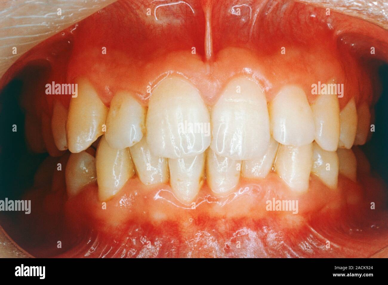 Treated gum inflammation. Clinical view of the teeth and gums of a ...