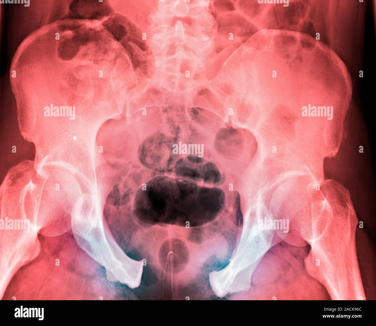 Pelvic fracture. Coloured X-ray of the pelvis of a 61 year old male ...