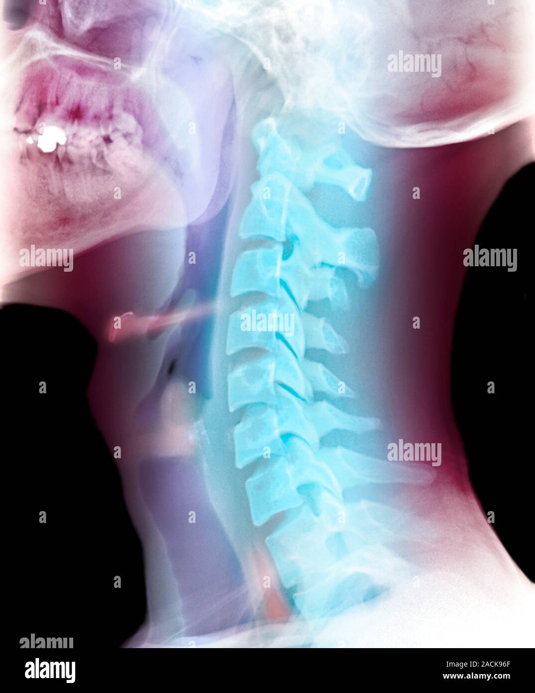 Noraml neck. Coloured X-ray of the healthy cervical (neck) spine of a ...