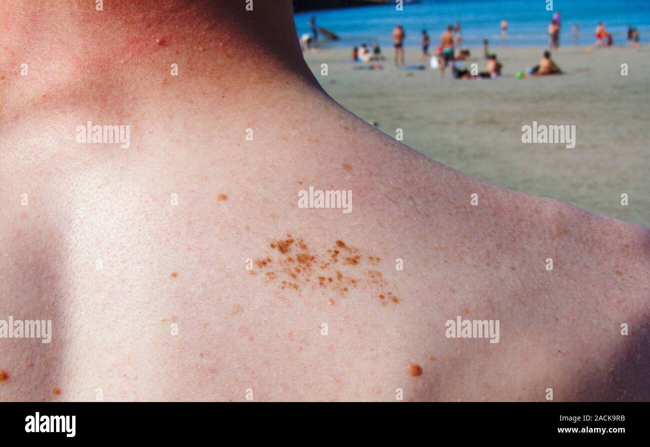 Skin pigmentation after sunburn. This pigmentation on the skin of the ...