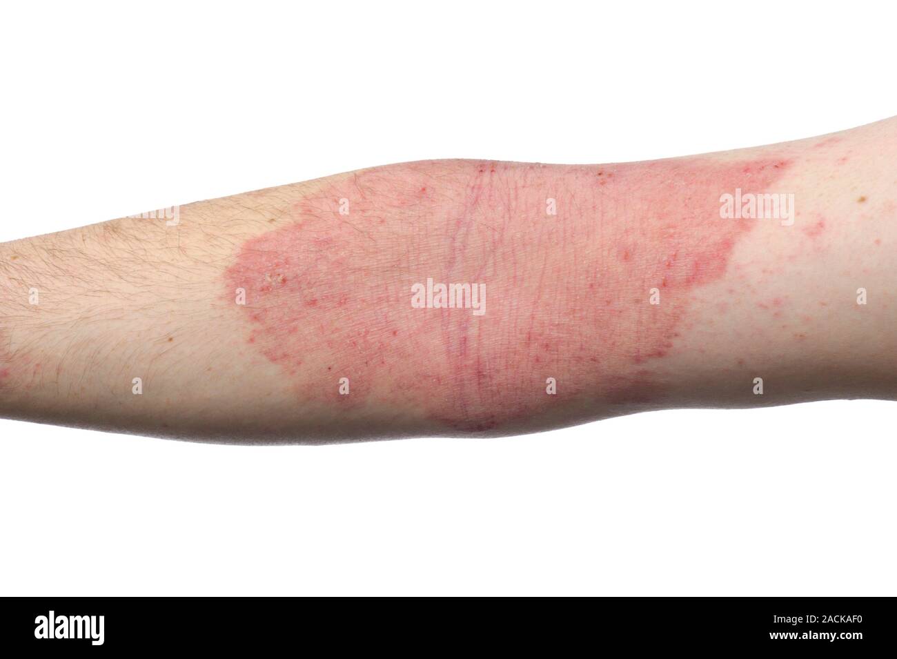 Not for use in Television Not for use in Television Red rashes in the ...