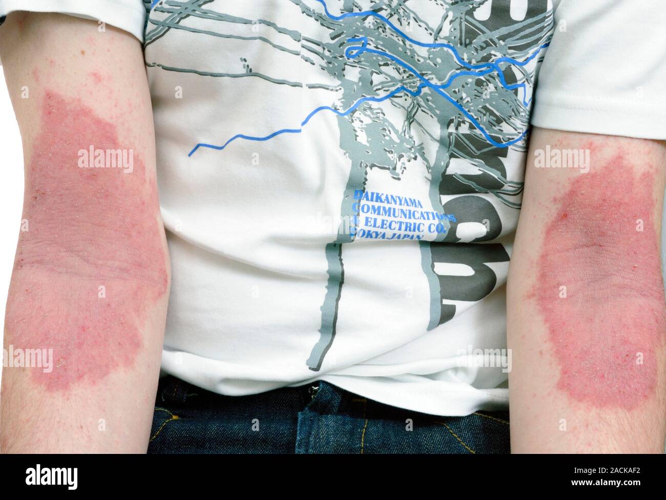 Not For Use In Television Not For Use In Television Red Rash In The Crook Of The Elbow Of The