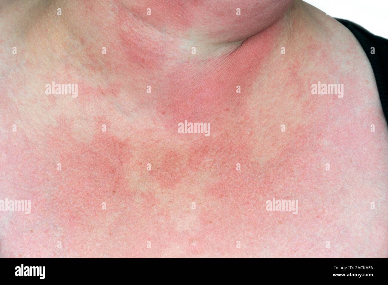 Not for use in Television Not for use in Television Rash across the ...