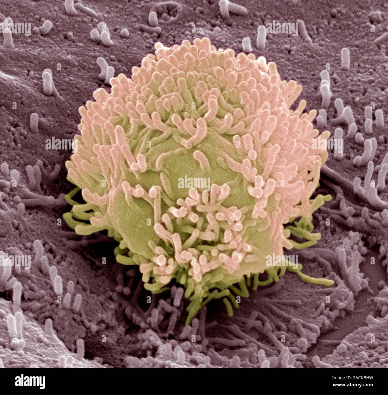 Colorectal cancer cell. Coloured scanning electron micrograph (SEM) of ...