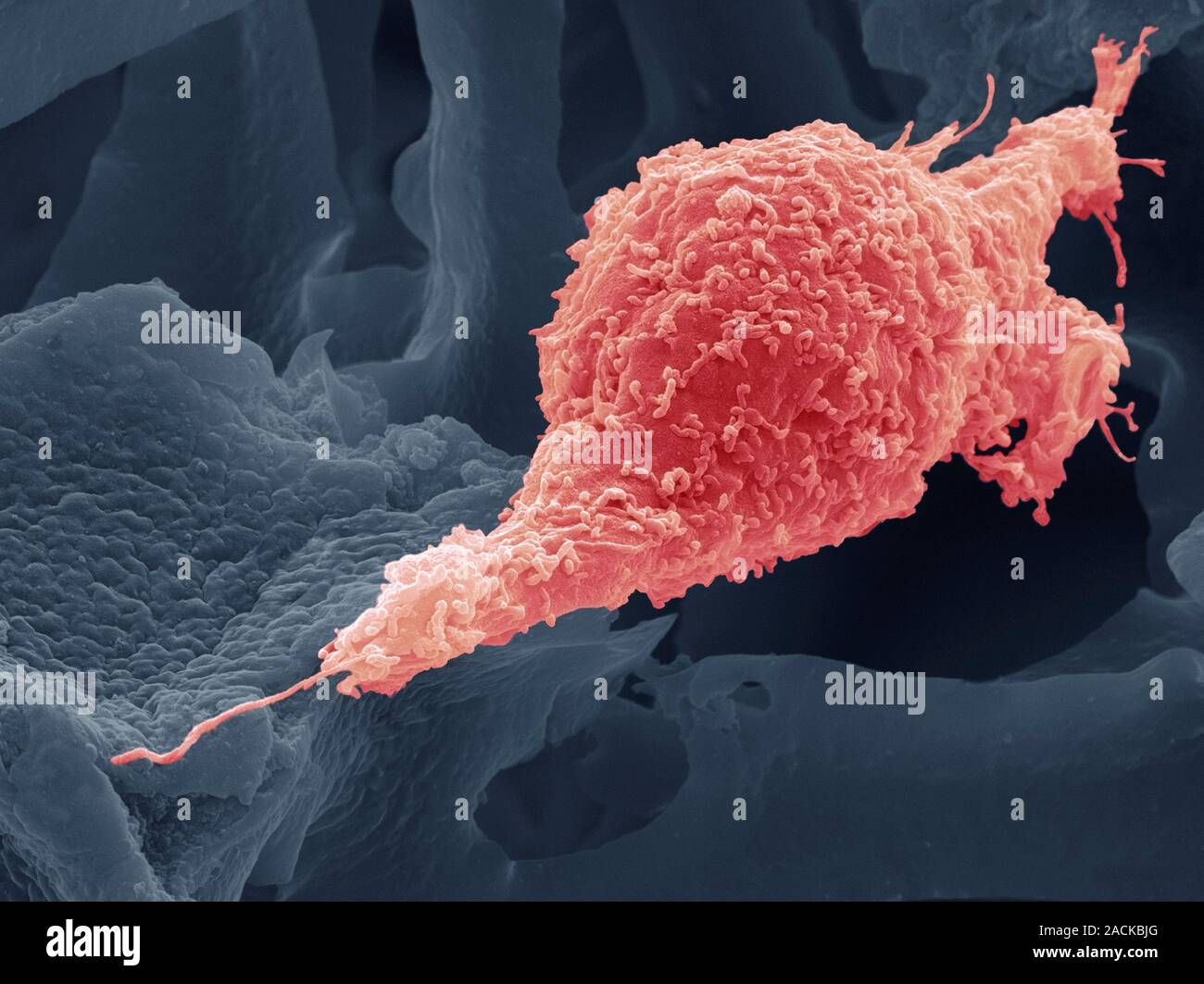 Cervical cancer cell. Coloured scanning electron micrograph (SEM) of a ...
