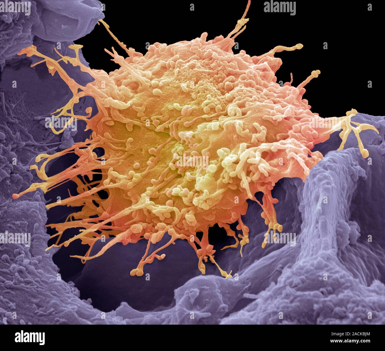 Cervical cancer cell. Coloured scanning electron micrograph (SEM) of a ...