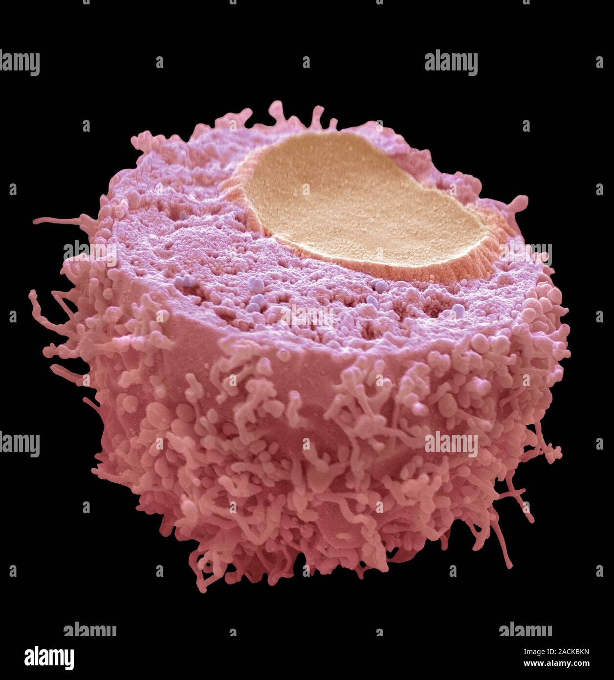 Cervical cancer cell. Coloured scanning electron micrograph (SEM) of a ...