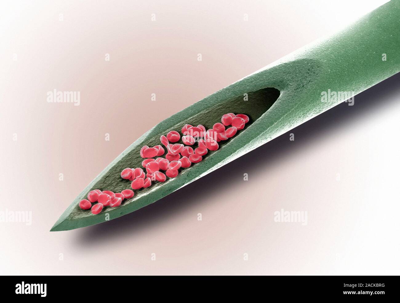 Blood on a needle. Composite coloured scanning electron micrograph (SEM ...