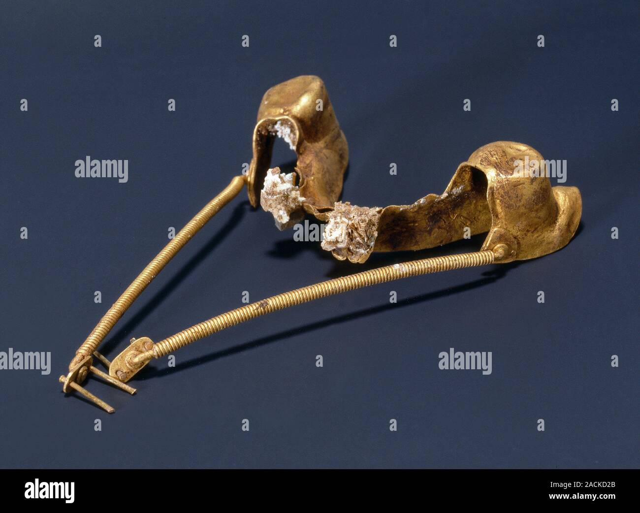 Gold lower jaw denture. This denture is formed from a sheet of gold ...