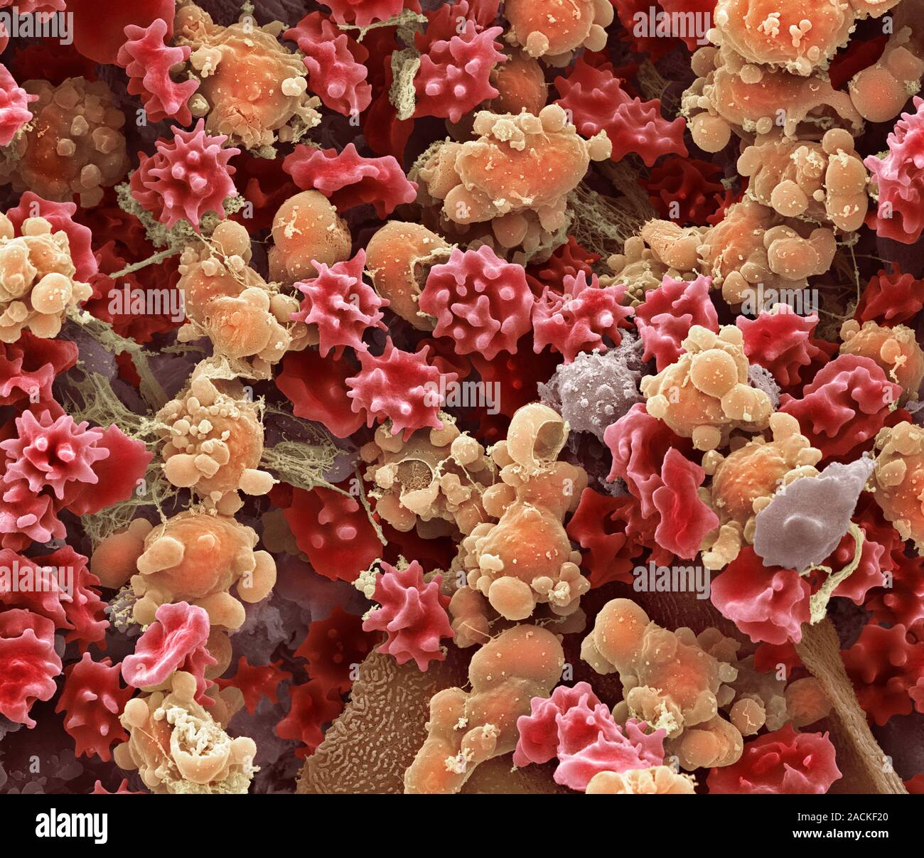 Cells from a urine infection. Coloured scanning electron micrograph ...