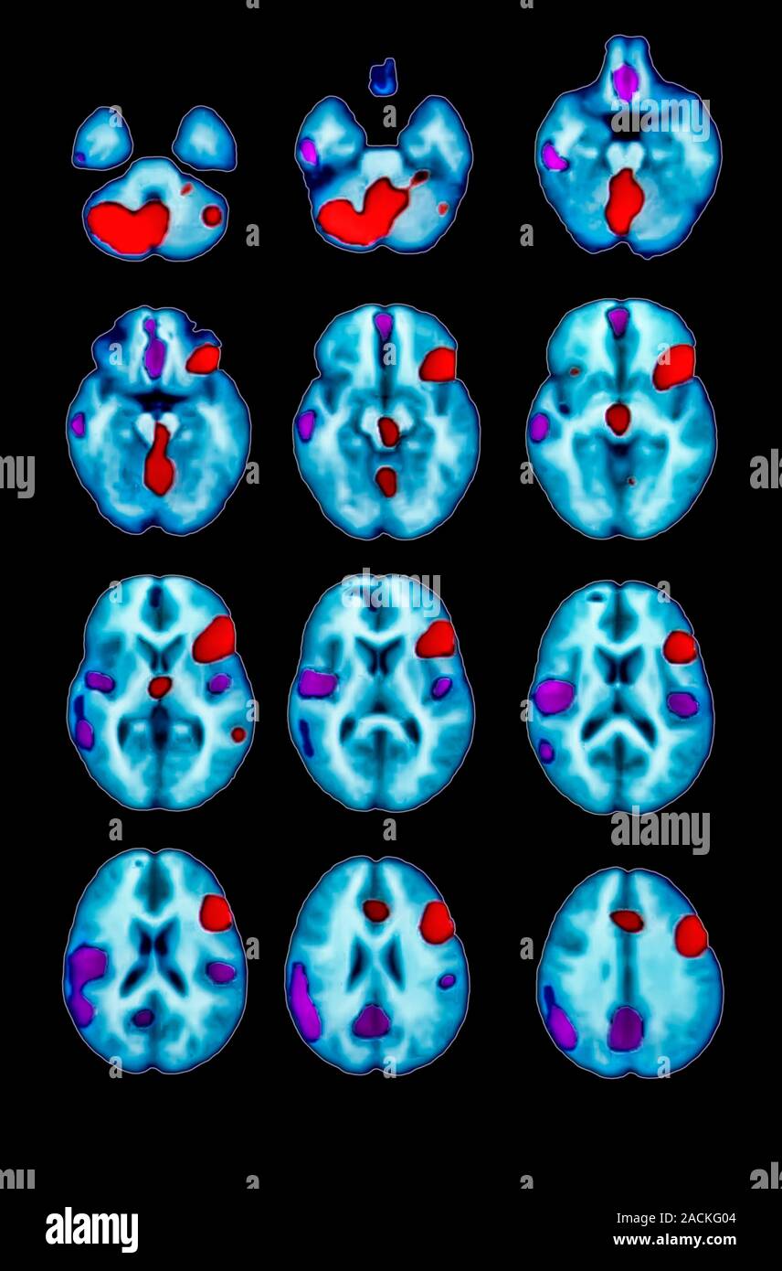 CT scans. Computed tomography (CT) scans of a patient's brain showing ...