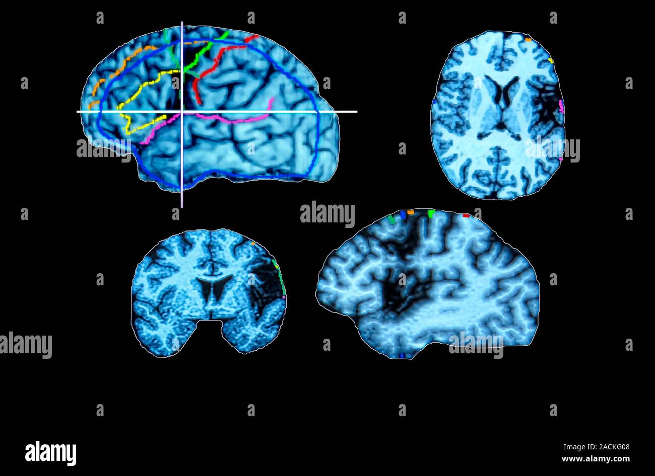 CT scans. Computed tomography (CT) scans of a patient's brain showing ...