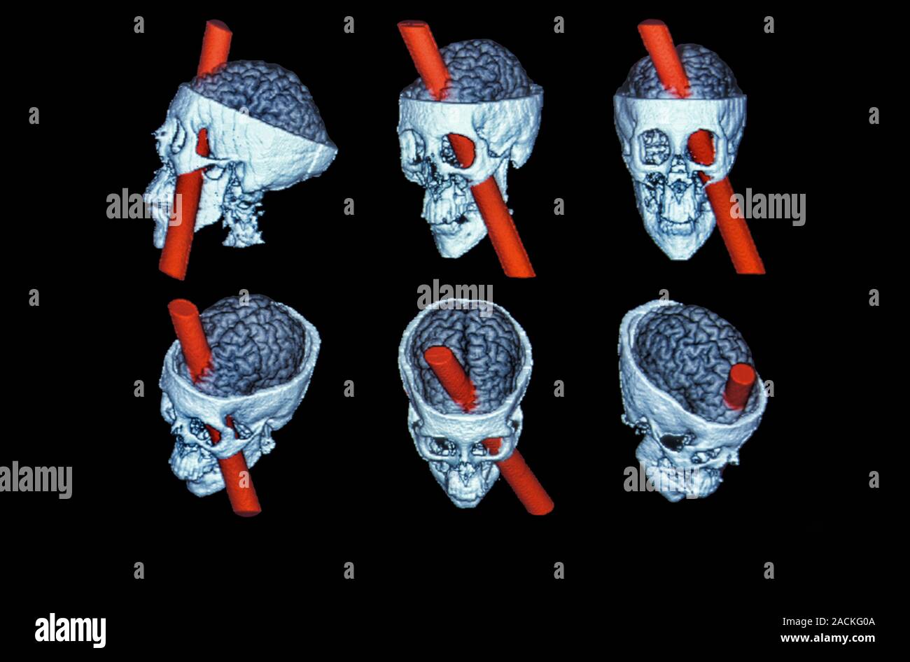 Phineas Gage brain reconstruction. Computer models of the brain of ...