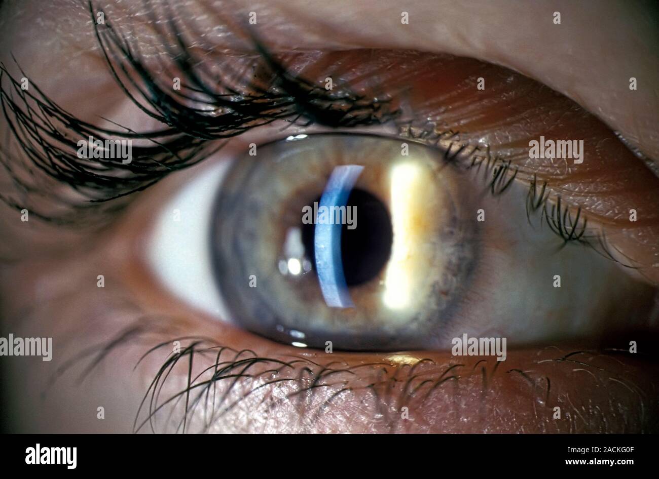 Slit lamp eye examination. Eye examination using a slit lamp. This instrument shines a fine beam ...
