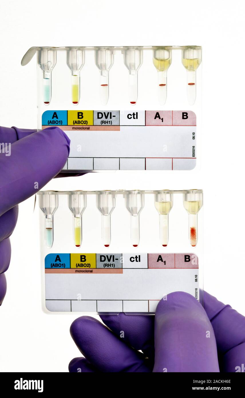 Laboratory tests for Rhesus (Rh) blood group showing a Rhesus positive ...