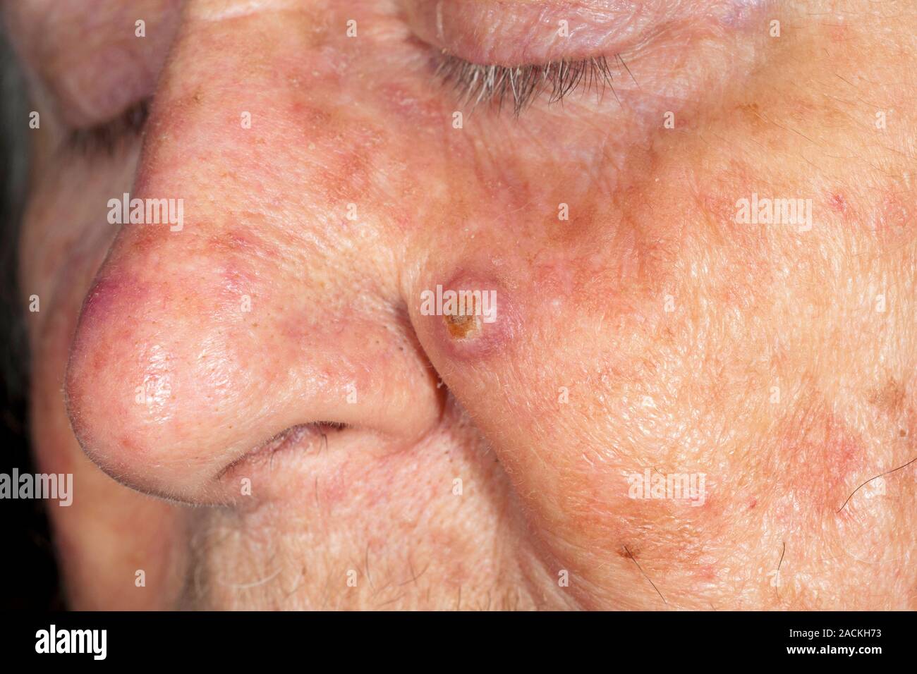 Close-up of a basal cell carcinoma (skin cancer) on the cheek of the ...