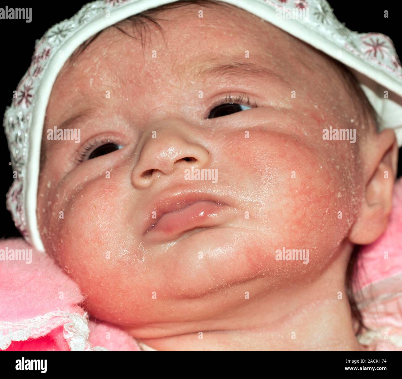 Red inflamed rash with scaling of the skin on the face in a baby a few ...