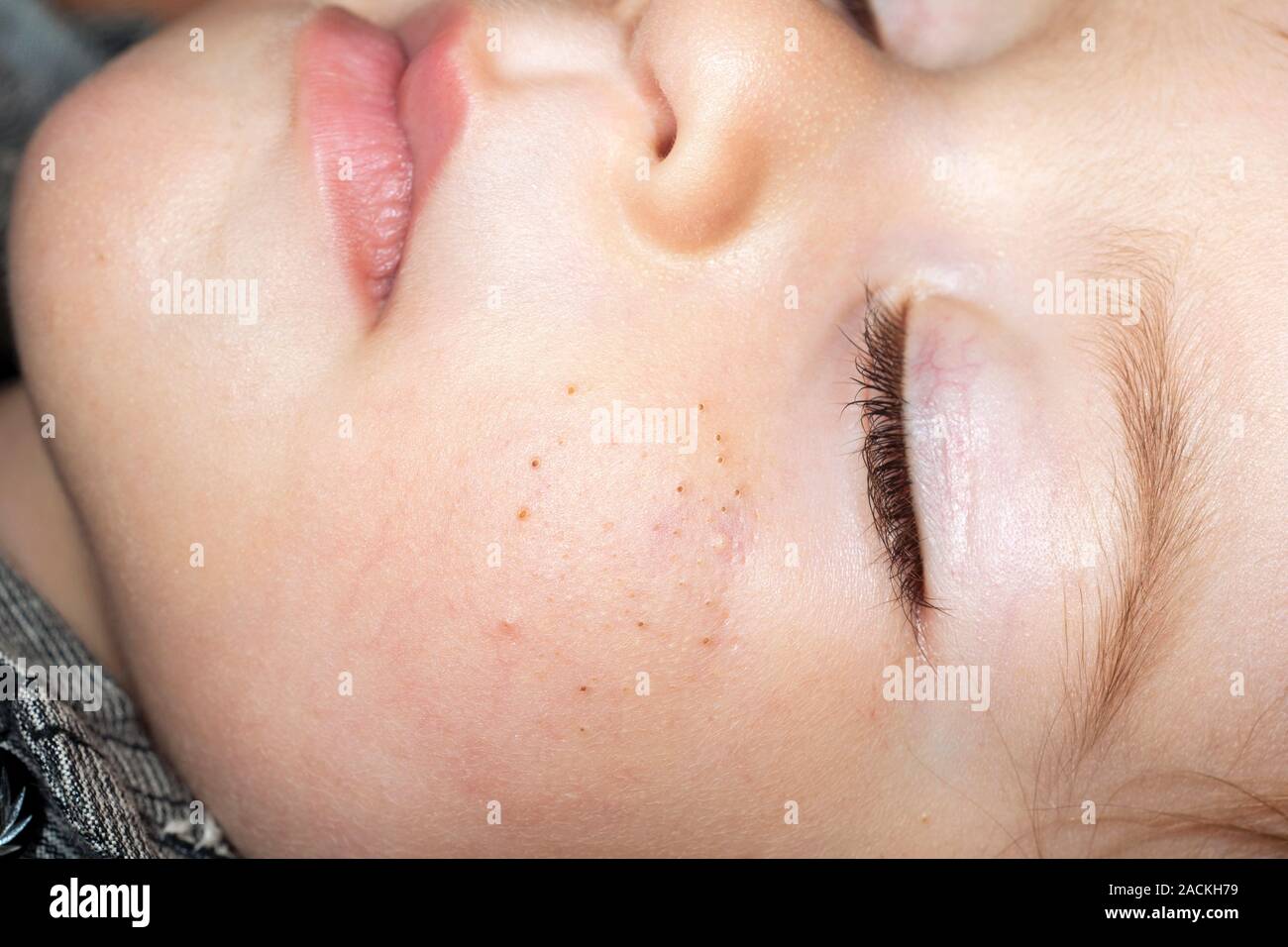 Pimples (pustules) on the reddened cheek of the face in a 3 year old ...