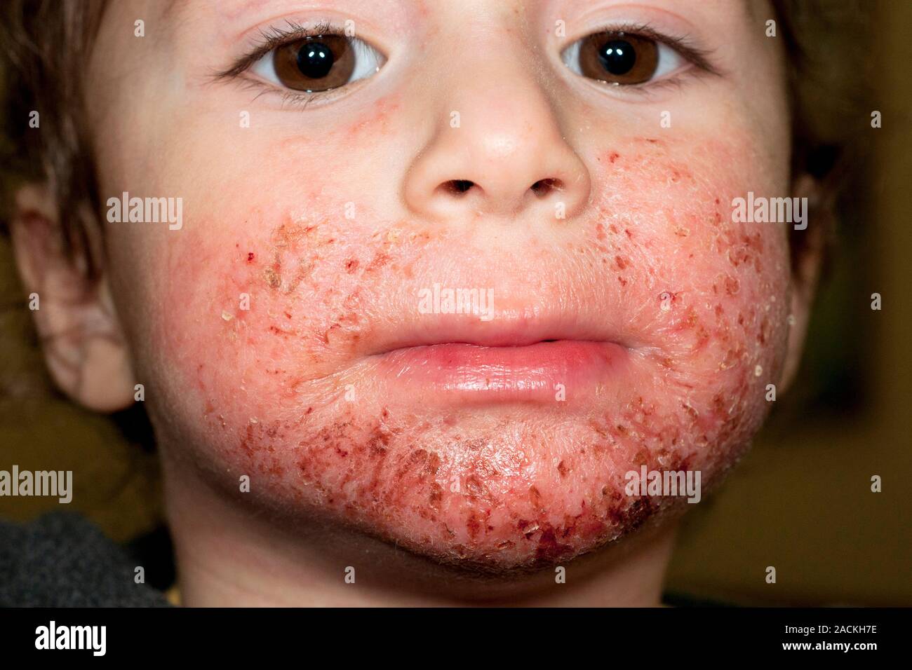 Red inflamed rash with scaling of the skin on the face in a 4 year old ...