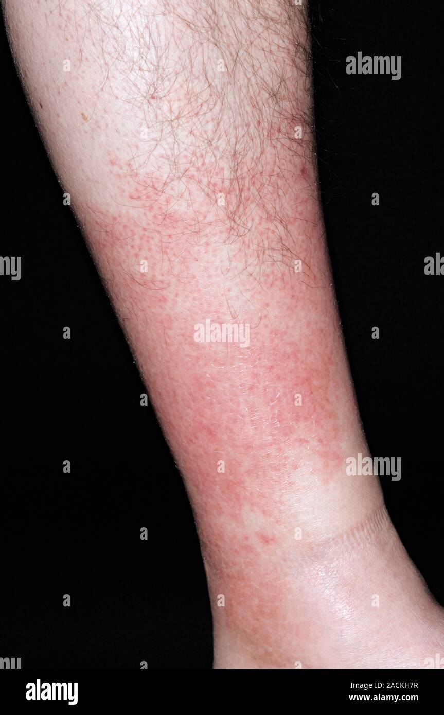 Red and inflamed shin of the leg in a 71 year old male patient showing ...