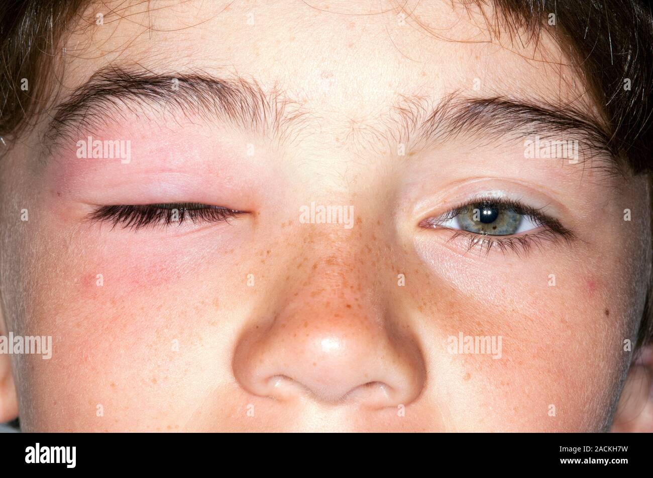 Red inflammation around the eye (periorbital) in a 10 year old male ...
