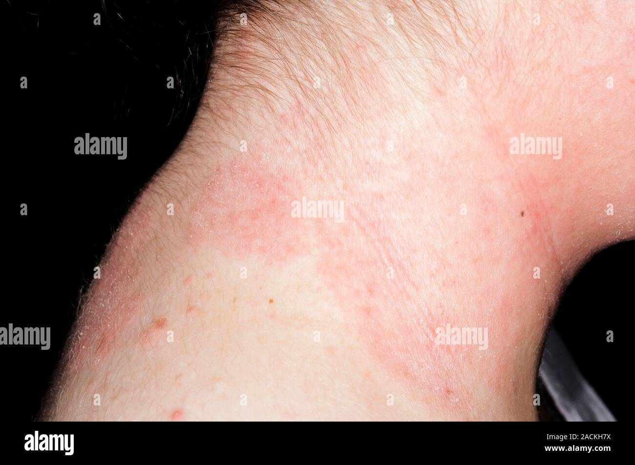 Skin reddening and scaling on the neck in a 16 year old female patient ...