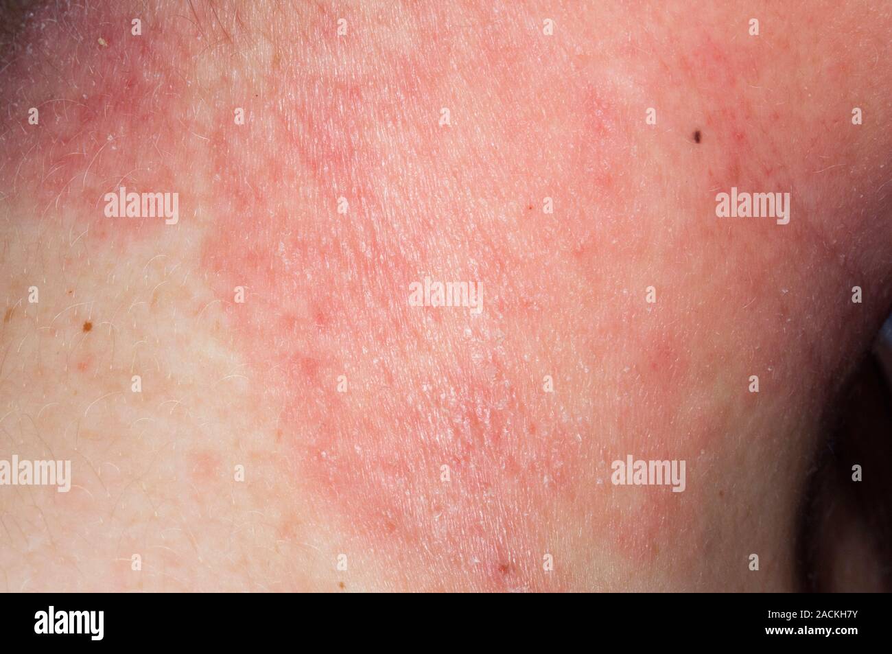 Skin reddening and scaling on the neck in a 16 year old female patient ...