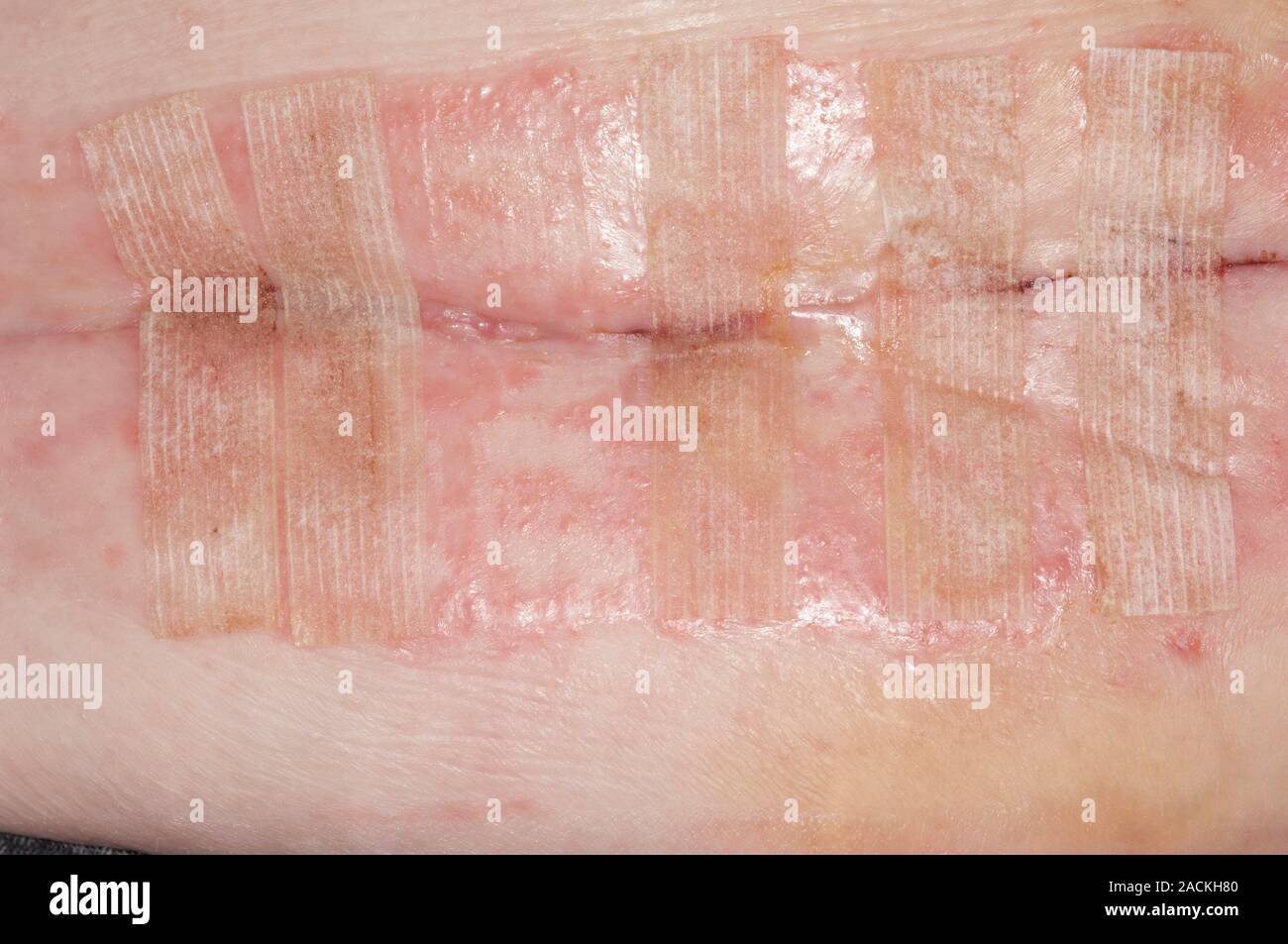 Close-up of a surgical wound sealed with steristrips in a 63 year old ...