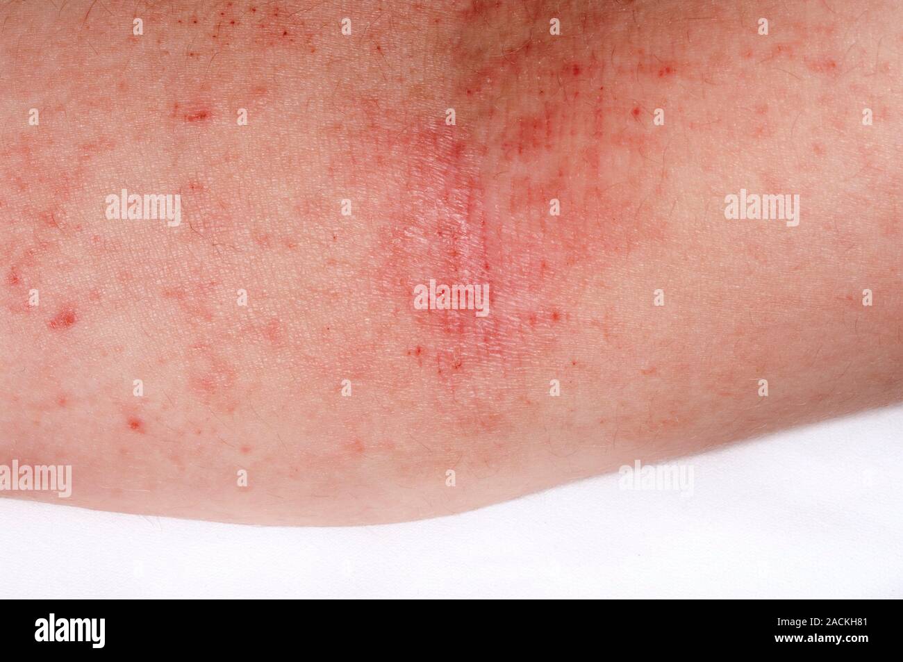 Skin reddening and scaling on the arm by the elbow in a 16 year old ...