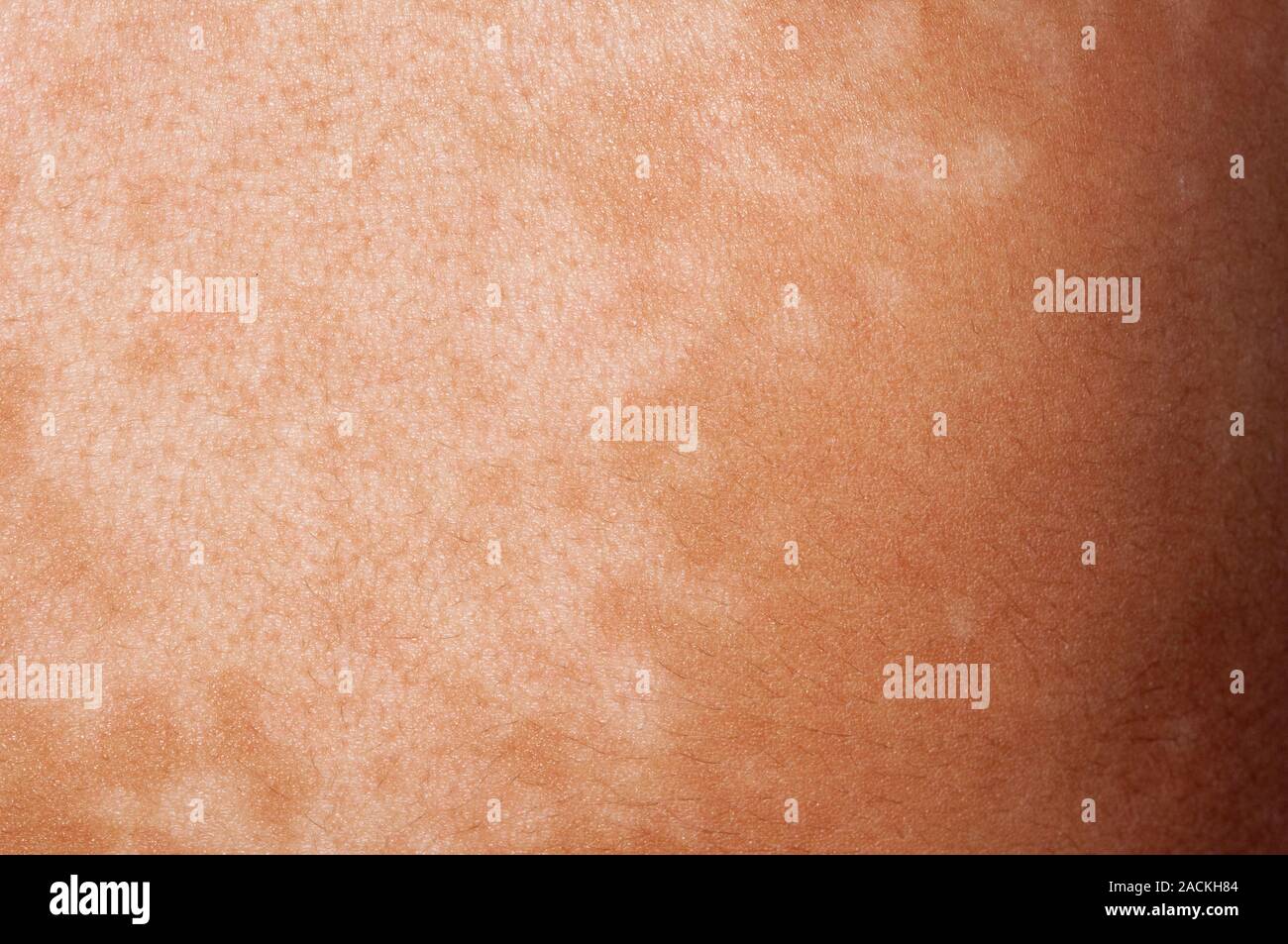 Close-up of a fungal skin infection (Pityriasis versicolor) on the back ...