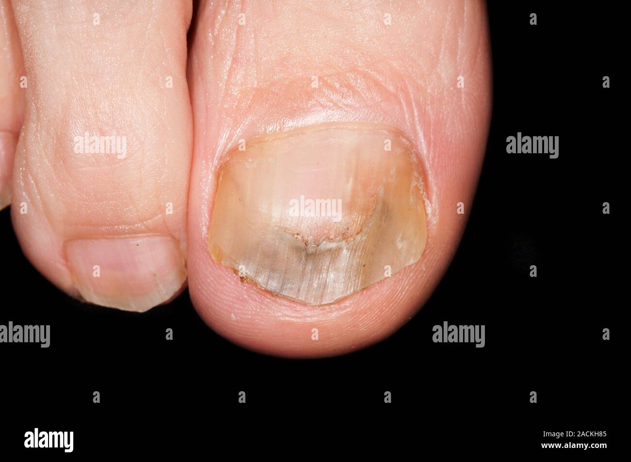 Close-up of the new healthy nail growing on the big toe in a 67 year ...